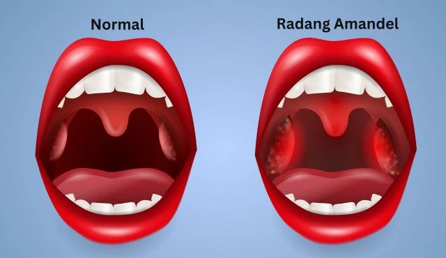 Apakah Radang Amandel Perlu Operasi? Pahami Gejalanya!