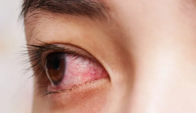 Kenali Gejala, Penyebab, dan Cara Mengatasi Rhinitis Alergi