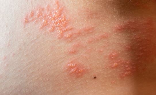 Cacar Air: Gejala, Penyebab, & Pengobatan yang Benar