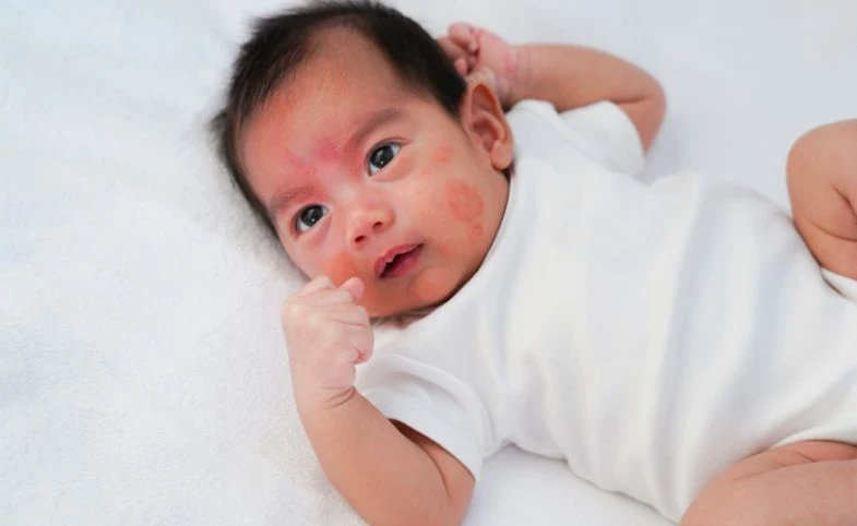 7 Jenis Penyakit Kulit pada Anak Paling Umum di Indonesia