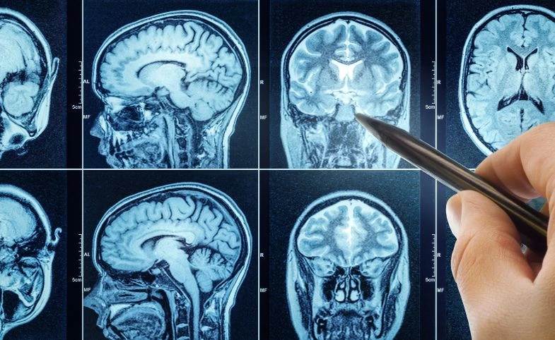 Kenali Tumor Otak, Gejala, Diagnosis & Pengobatannya