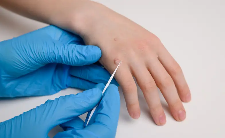 Cara Menghilangkan Kutil Sampai Akarnya dengan Cepat