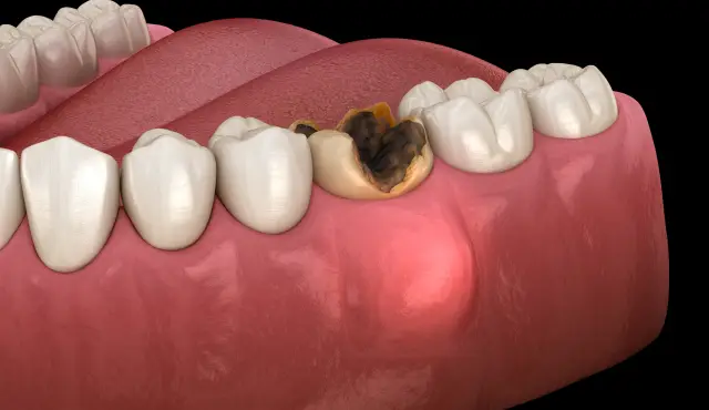 Mengenal Abses Gigi, Penyebab, Gejala, hingga Pengobatannya